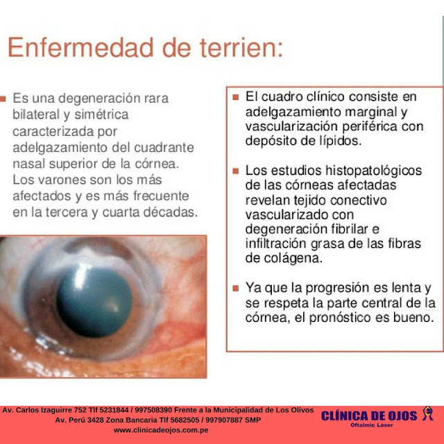 Clínica de Ojos Oftalmic Láser: ENFERMEDAD DE TERRIEN