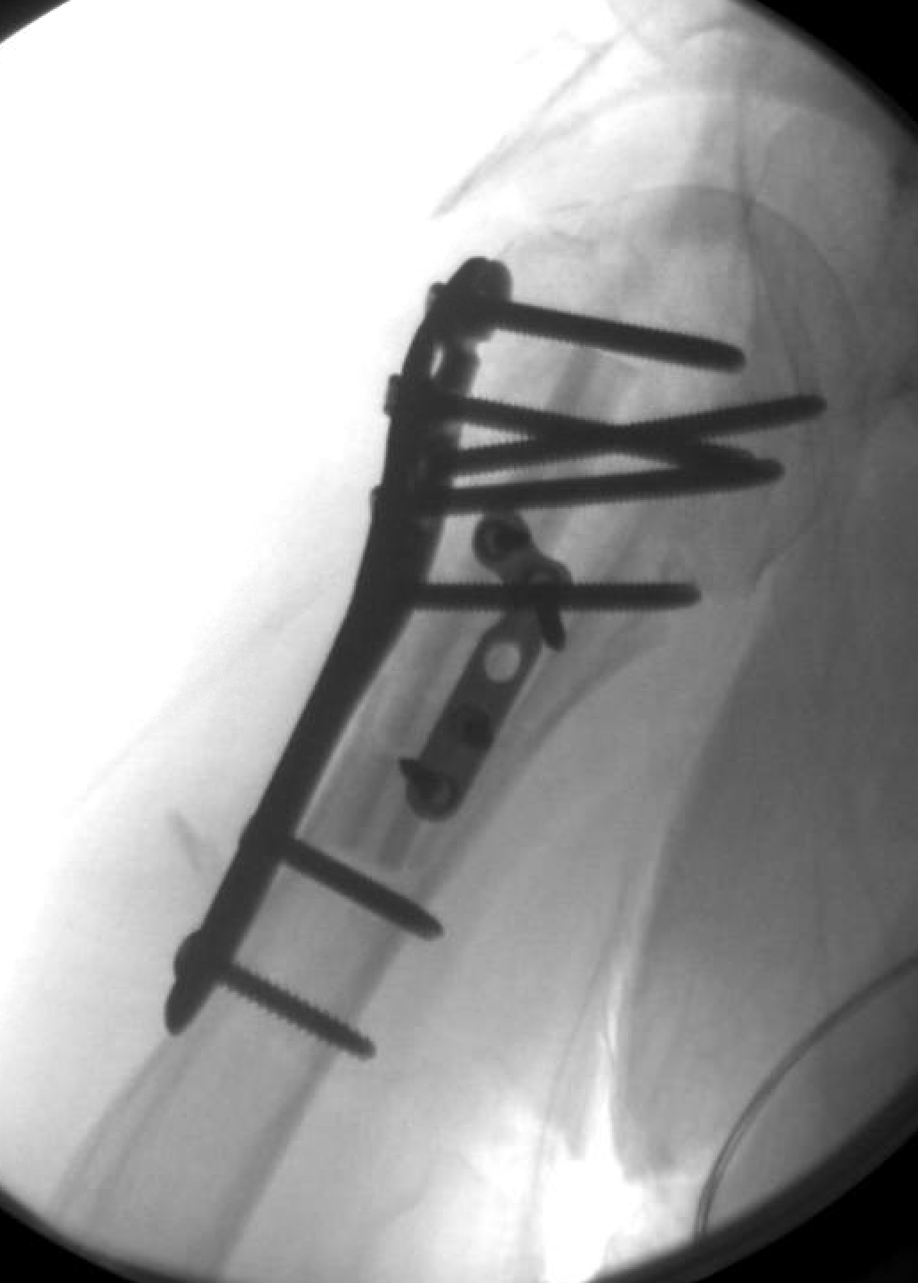 Shoulder and Elbow Surgery: Open reduction and internal fixation of a 4 ...