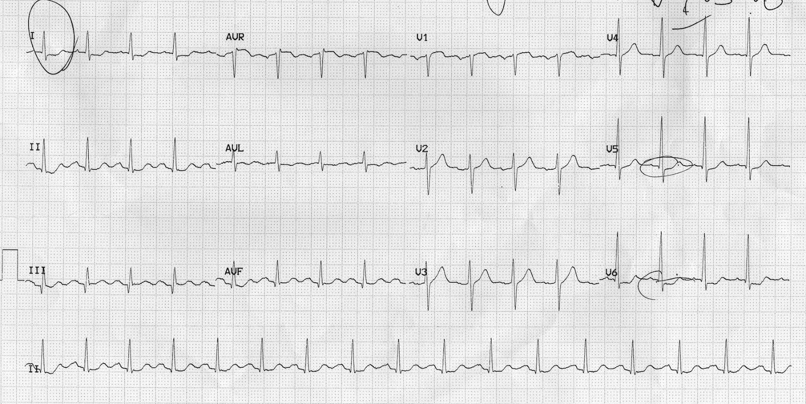 Iskemia Miokardium | INA - ECG
