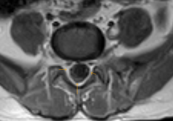 Arachnoiditis-MRI - Sumer's Radiology Blog