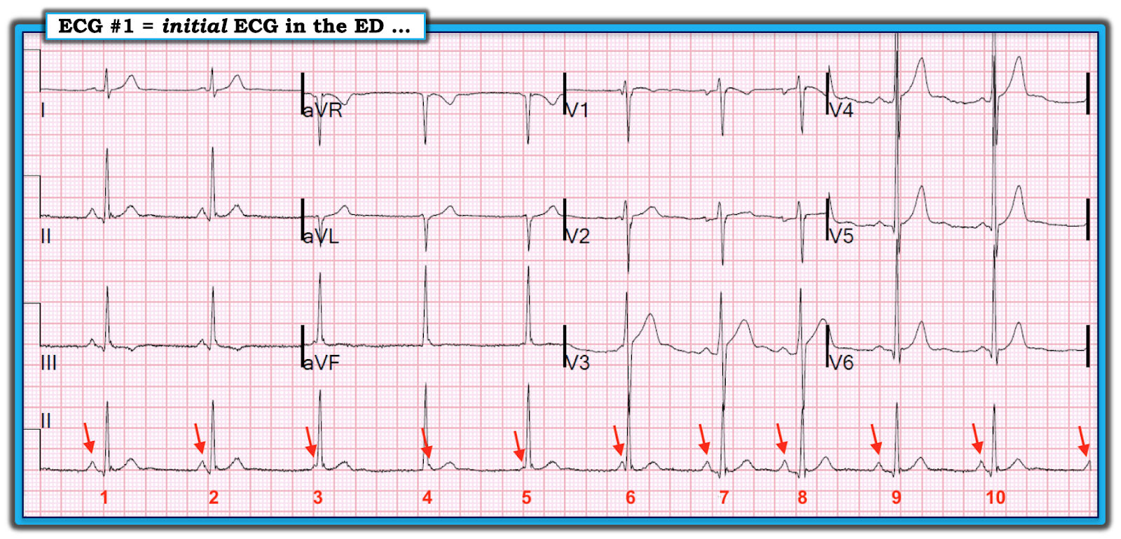 Dr. Smith's ECG Blog: What is the Rhythm?