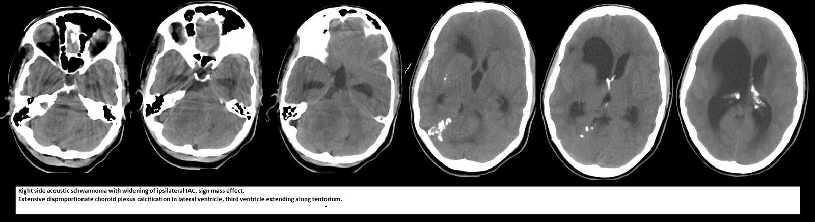 Dr Balaji Anvekar FRCR: Intracranial calcifications