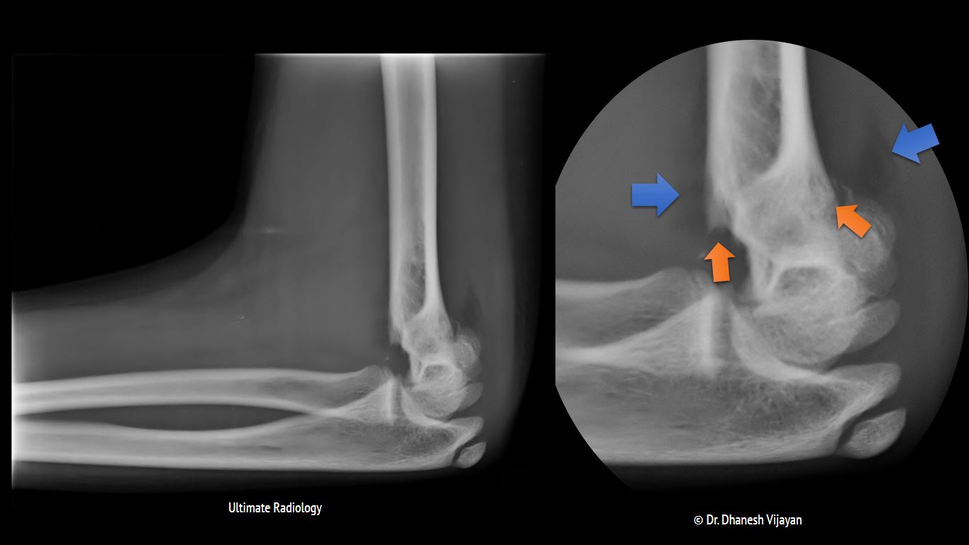 Ultimate Radiology : Supracondylar humeral fracture