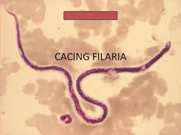 Waspada Cacing Filaria Penyebab Kaki Gajah