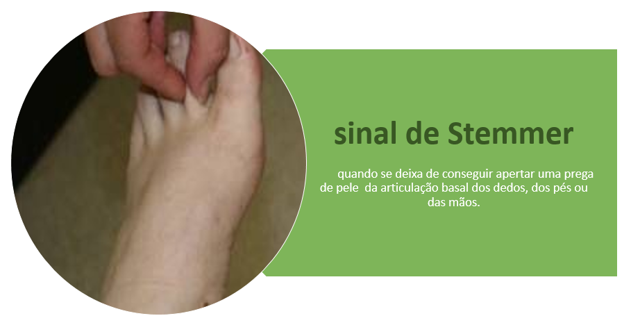 L de linfa: Lipedema,vs linfedema - efeitos no sistema linfático