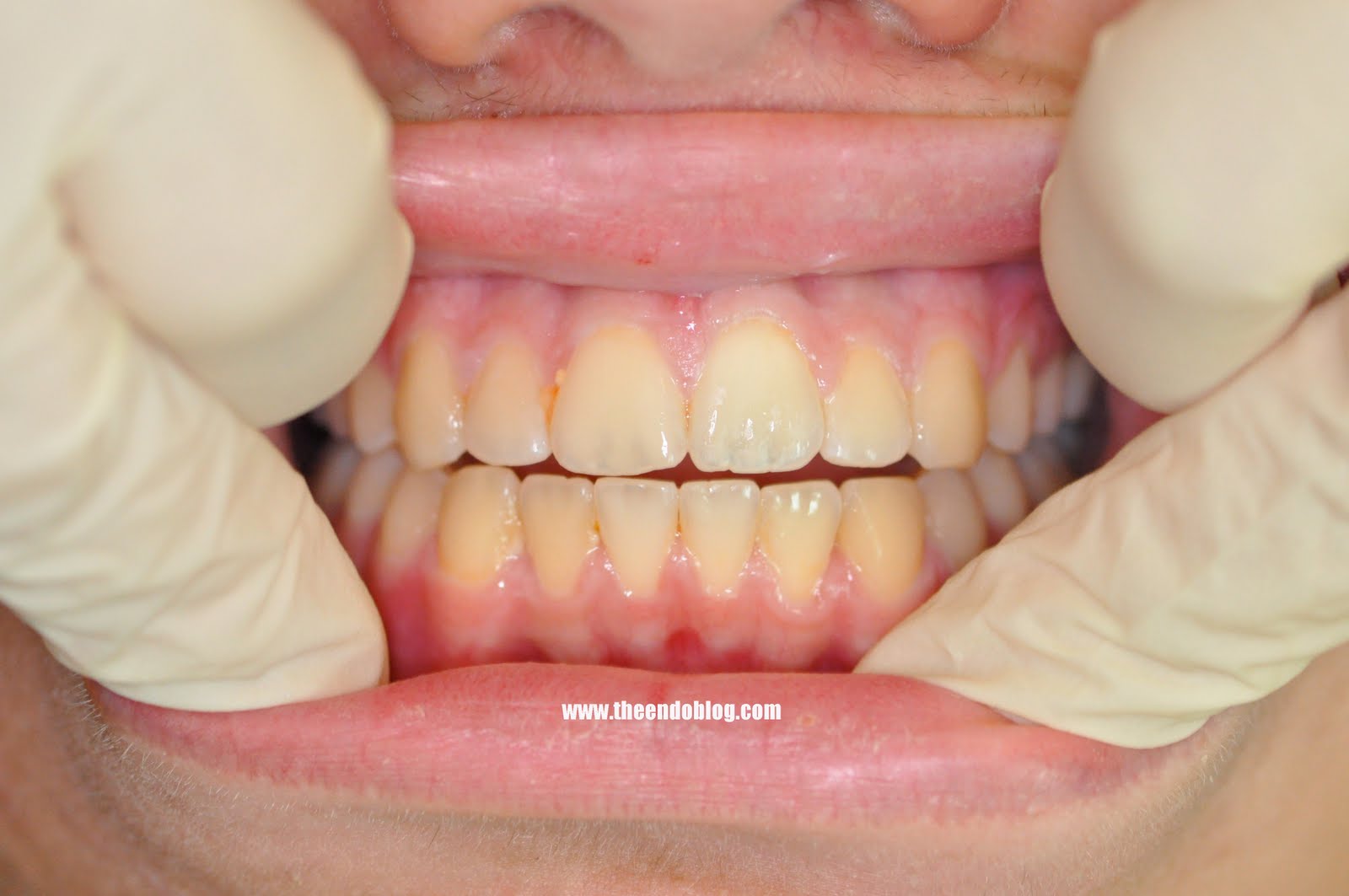 Dental Dominion: Calcific Metamorphosis (Pulpal Obliteration) and ...