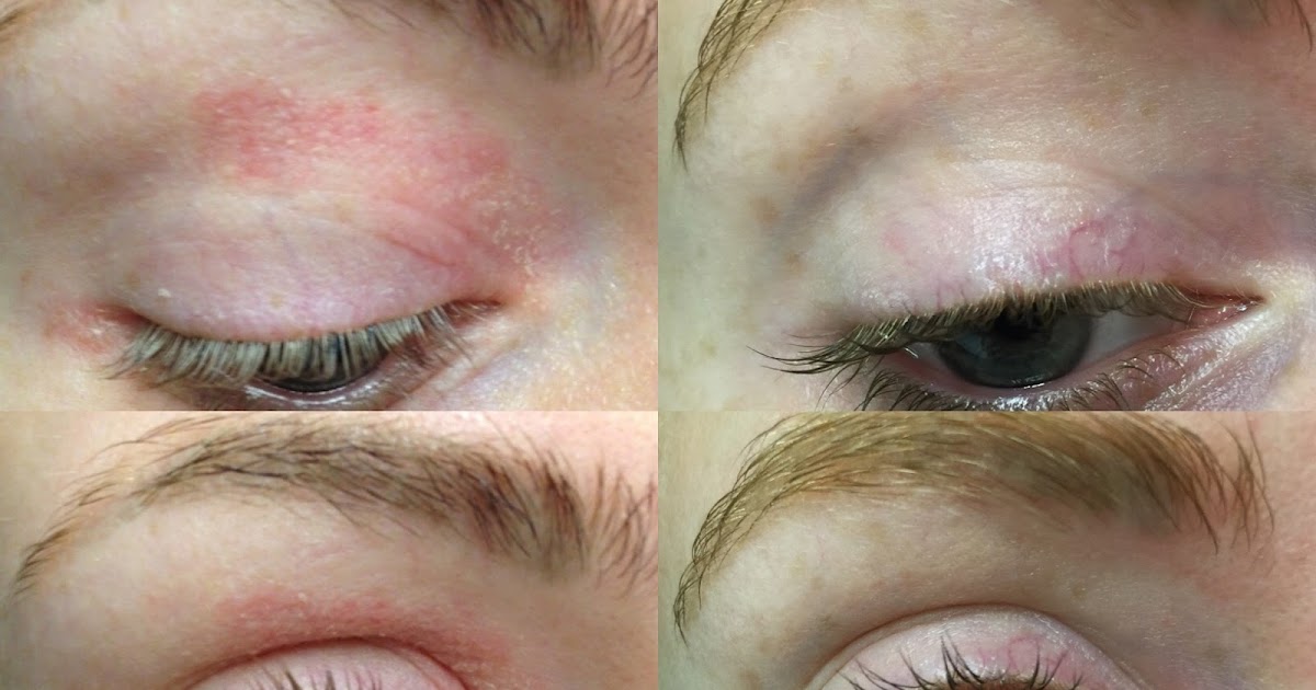 WIFELIFE: My experience with Seborrheic Dermatitis and how i got rid of it.