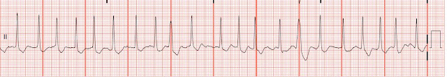 EKG Rhythm Strip Quiz 1