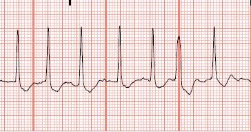 EKG Rhythm Strips 25: Ectopic beats