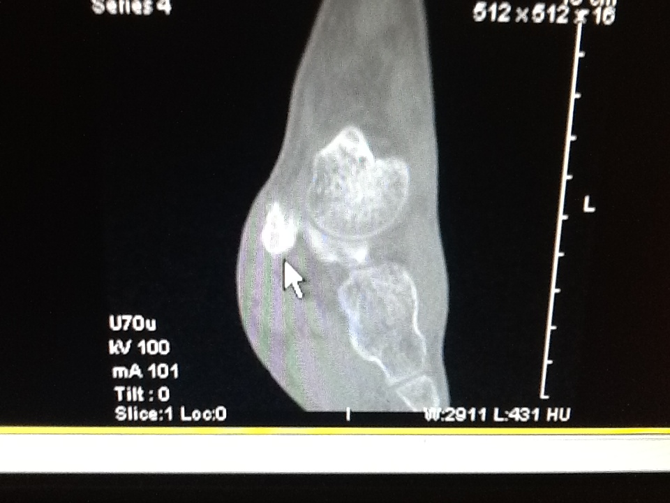 Foot and Ankle Problems By Dr. Richard Blake: Images for Os Navicularis ...