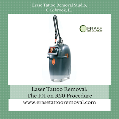 Erase Tattoo Removal: Laser Tattoo Removal: The 101 on R20 Procedure