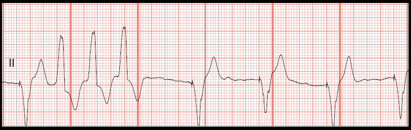 Basic EKG Rhythm Test 30