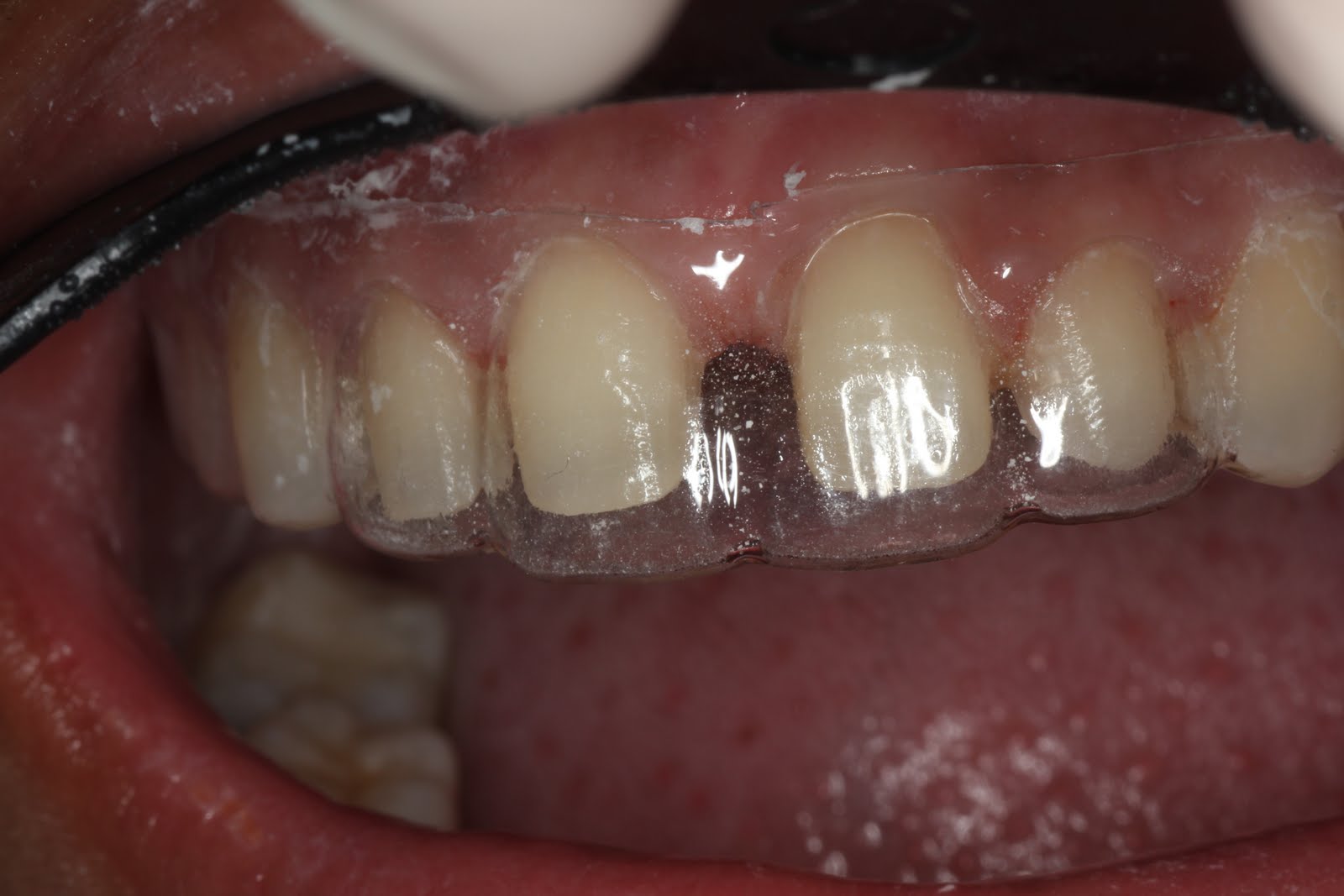 The DMD and MDT Learning Blog: Diastema Closure Steps to Success