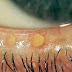 Impaired Skin Integrity and Disturbed Body Image related to Blepharitis ...