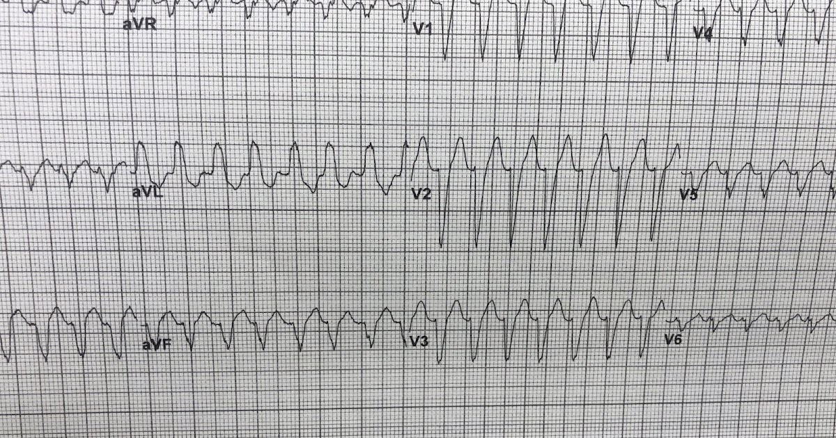 Dr. Smith's ECG Blog: Ventricular Tachycardia? Or SVT with Aberrancy?