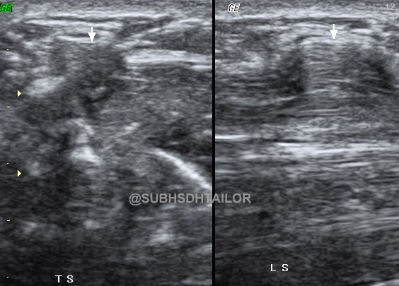 SONO DIGEST: ULTRASOUND EVALUATION OF MUSCLE HERNIA