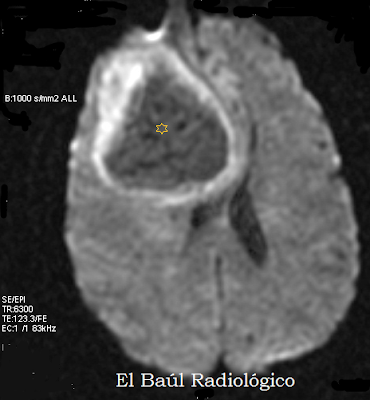 El Baúl Radiológico: 3) "DROP" METÁSTASIS. DISEMINACIÓN METASTÁSICA ...