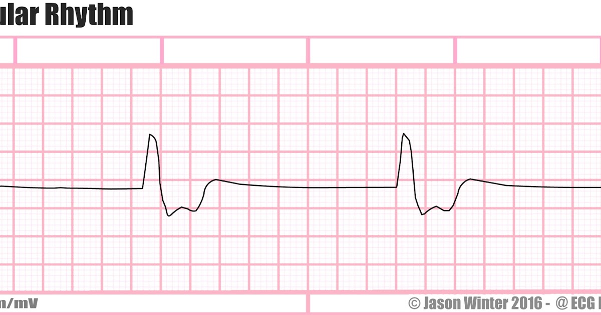 ECG Educator Blog : Idioventricular Rhythm