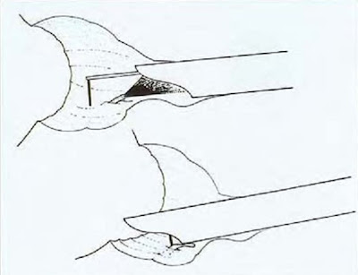 How to perform TURP? (post) step-by-step operative urology series