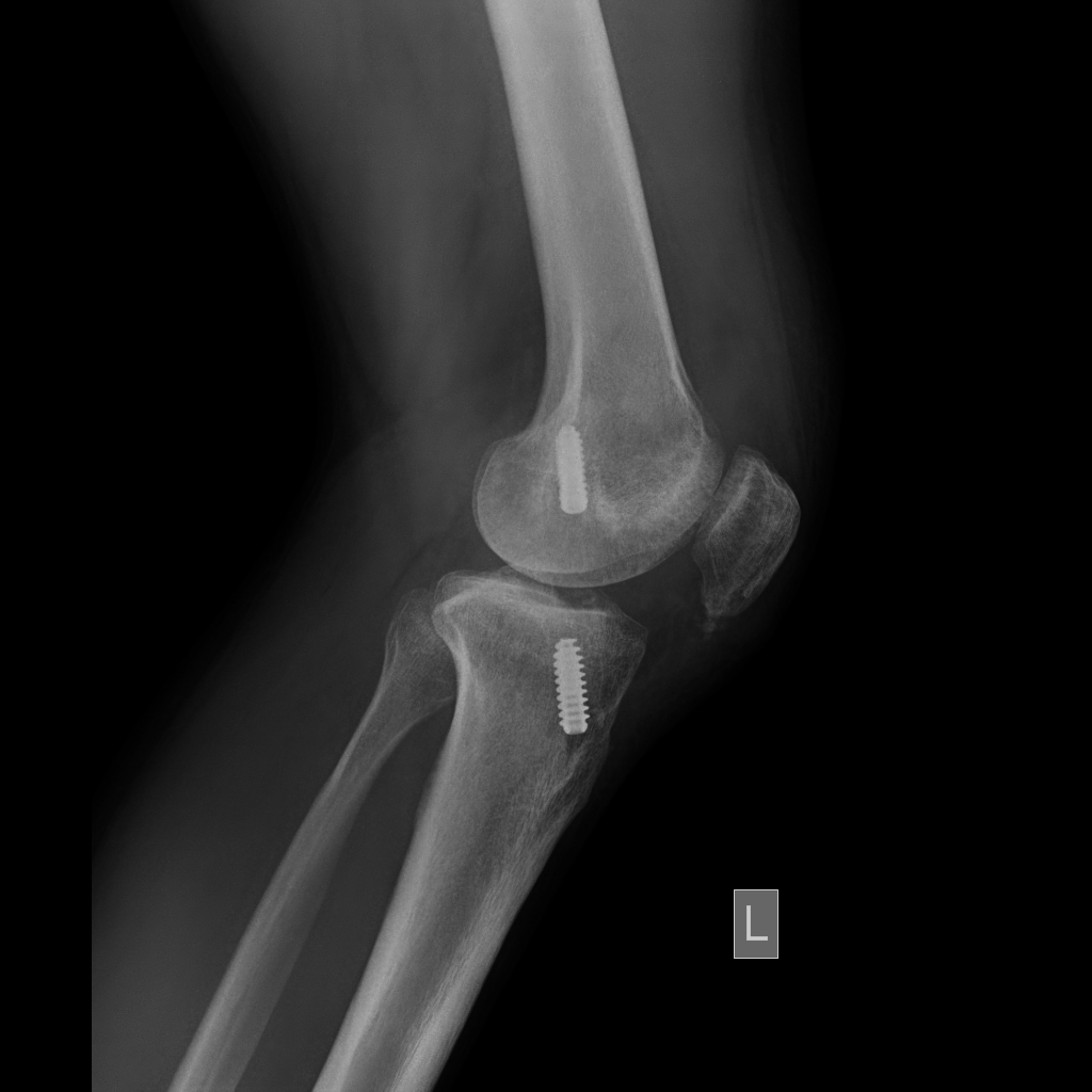 Joint Preservation and Replacement : Revision ACL