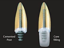 Dental Perception: Art of restoring a badly decayed/fractured teeth