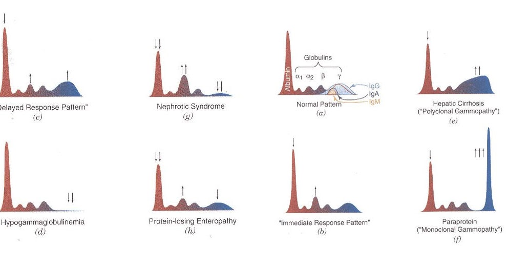 Medical Laboratory and Biomedical Science: Serum Protein Electrophoresis Medical Laboratory and Biomedical Science: Serum Protein Electrophoresis