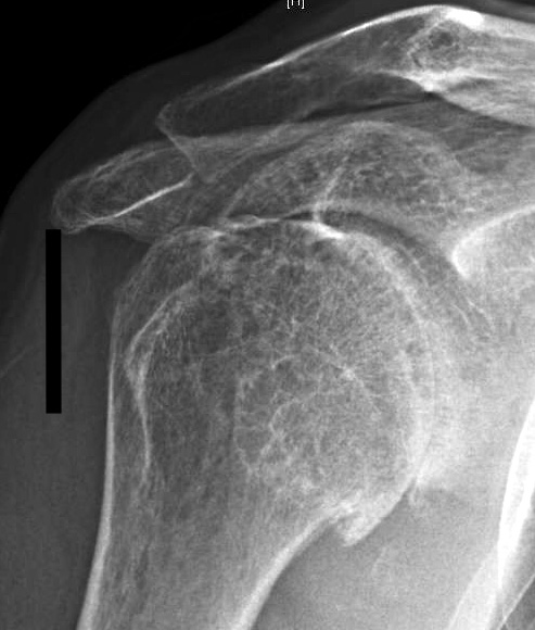 UW Shoulder and Elbow Academy: Lateral humeral offset in shoulder ...