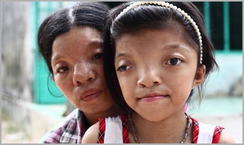 Vietnam Urges Monsanto To Finally Pay For Horrifying Mutations Brought ...