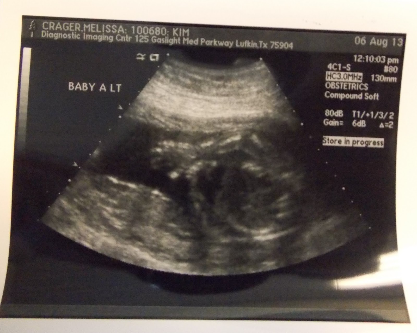 22 week ultrasound