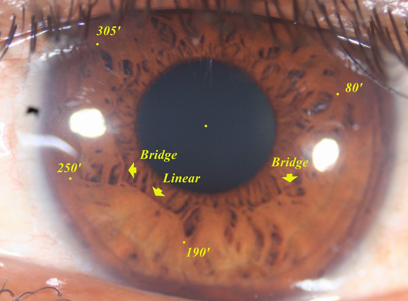 Modern & Multidimensional Iridology: Iris Sign That Enhanced The ...
