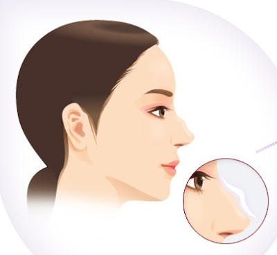 BK Plastic Surgery: BK STYLE SMART NOSE - Hooked Nose Reshaping