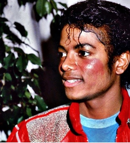 Cartas para Michael: Lúpus e vitiligo, dois desafios para Michael Jackson