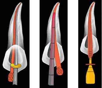 Dentistry and Medicine: Purpose of Root Canal Obturation and method of ...