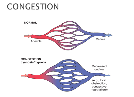 MBBS Medicine (Humanity First): Hyperemia and Congestion