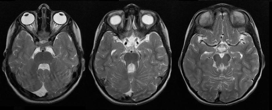 Dr Balaji Anvekar FRCR: Joubert syndrome MRI