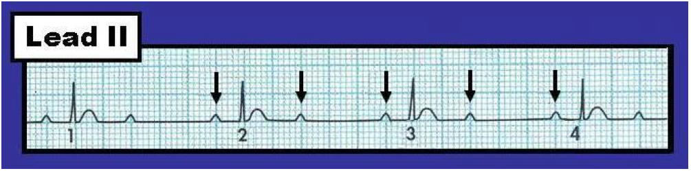 ECG Interpretation: ECG Interpretation Review #20 (High-Grade AV Block ...