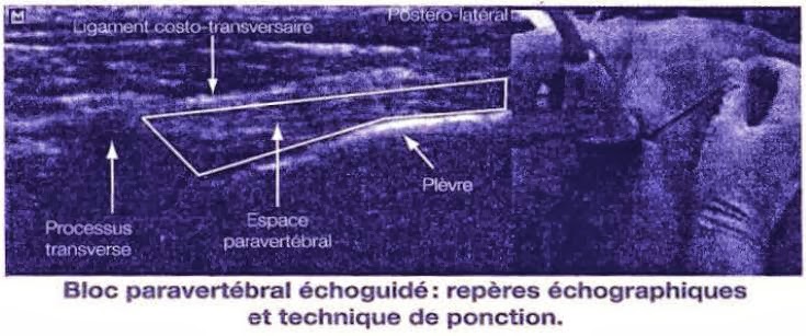 BLOC PARAVERTÉBRAL