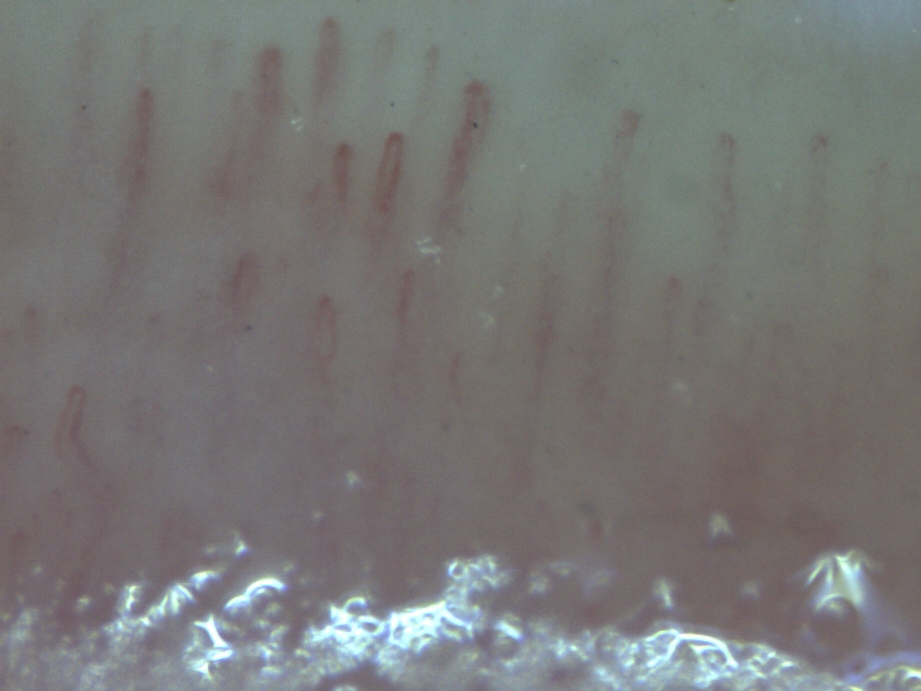 Rheumatologe: Trophic disturbance in nail growth