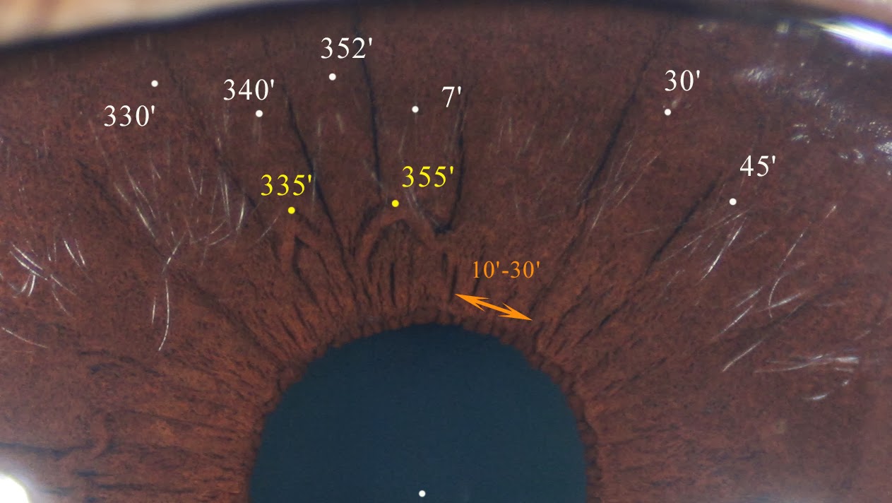 Modern & Multidimensional Iridology: IPB Morphologies, Pupil Flatness ...