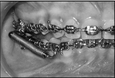 ORTODONTIA CONTEMPORÂNEA: Mini-implantes vs aparelhos funcionais fixos ...