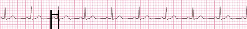 Dentistry and Medicine: ECG Rhythm Interpretation-How to Analyze a Rhythm