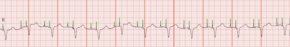 EKG Rhythm Strip Quiz 38