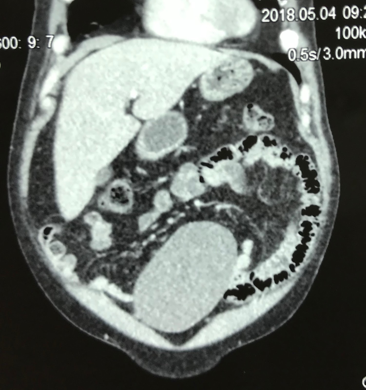 VIETNAMESE MEDIC ULTRASOUND: CASE 492 : APPENDICULAR MUCOCELE, Dr PHAN ...