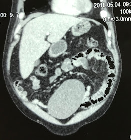 VIETNAMESE MEDIC ULTRASOUND: CASE 492 : APPENDICULAR MUCOCELE, Dr PHAN ...