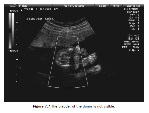 Staging of | Twin-Twin Transfusion Syndrome (TTTS)