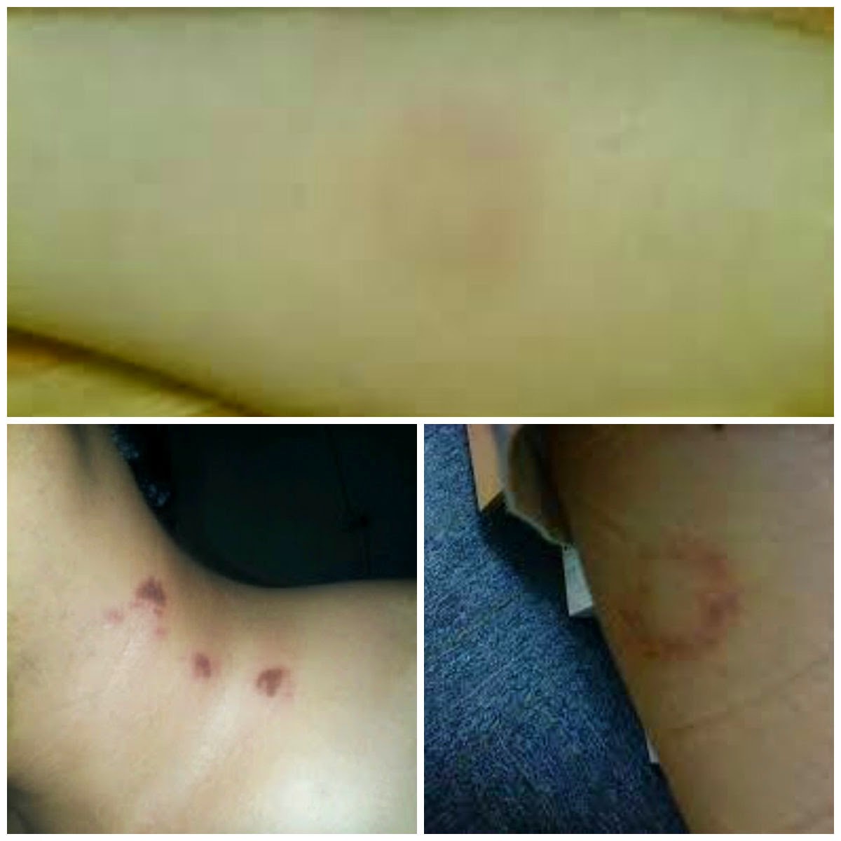 Lebam Pada Bahagian Kaki Dan Peha Mungkin Perbuatan Jin? | AKU KE