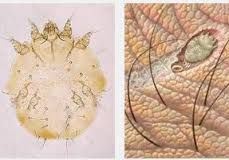 Cara Mudah Mengatasi penyakit Kudisan ~ Herbal Obat Gatal