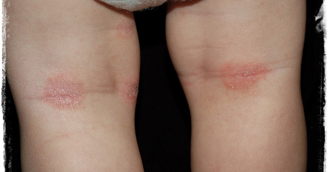 ¿Cómo controlar la dermatitis atópica? | Con P de Pediatría