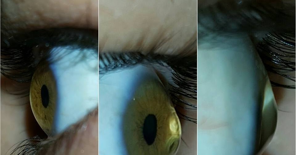 Keratoconus (Conical Cornea) Photo Taken with a Galaxy Note 5 ...