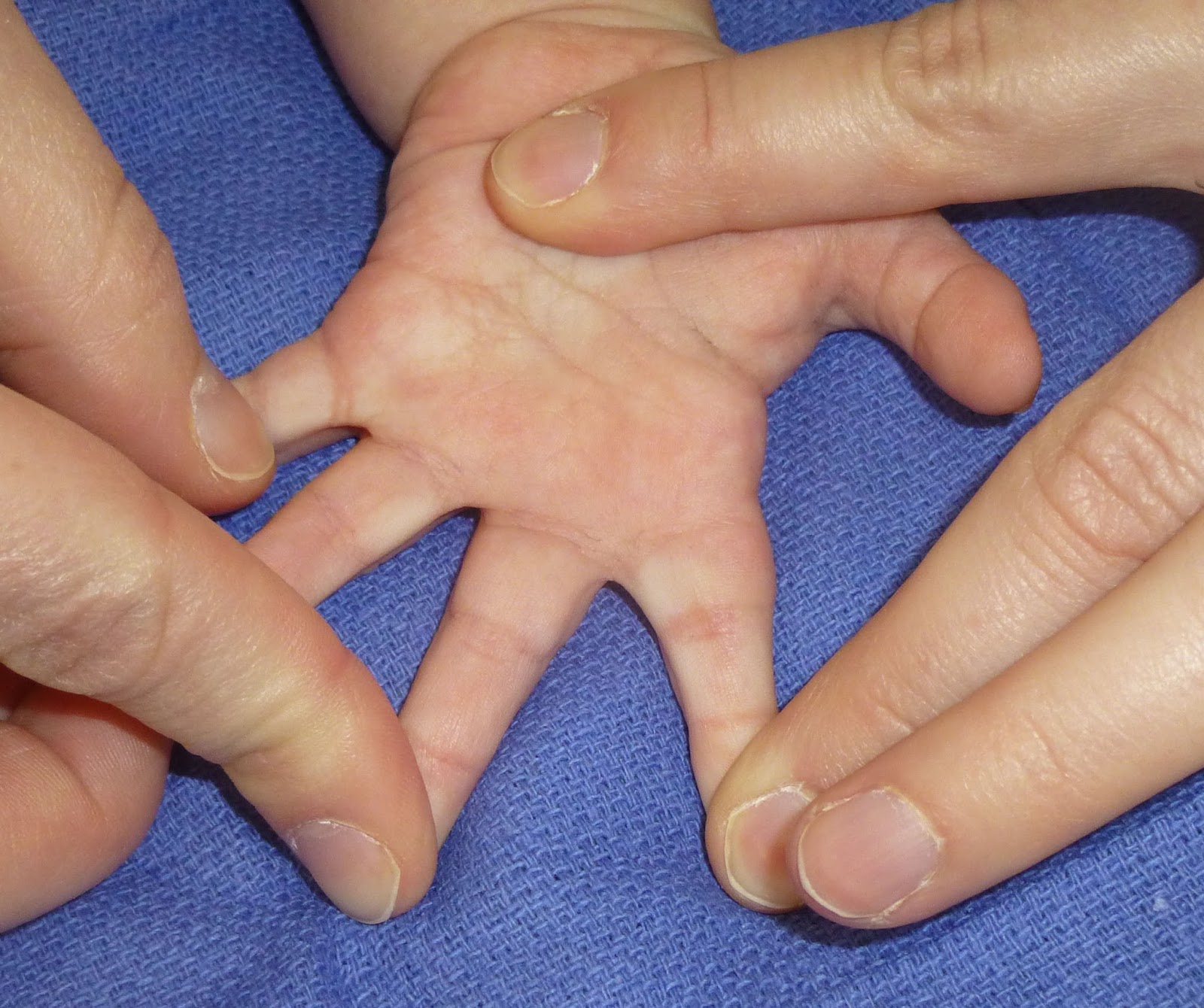 Partial Syndactyly | Congenital Hand and Arm Differences | Washington ...